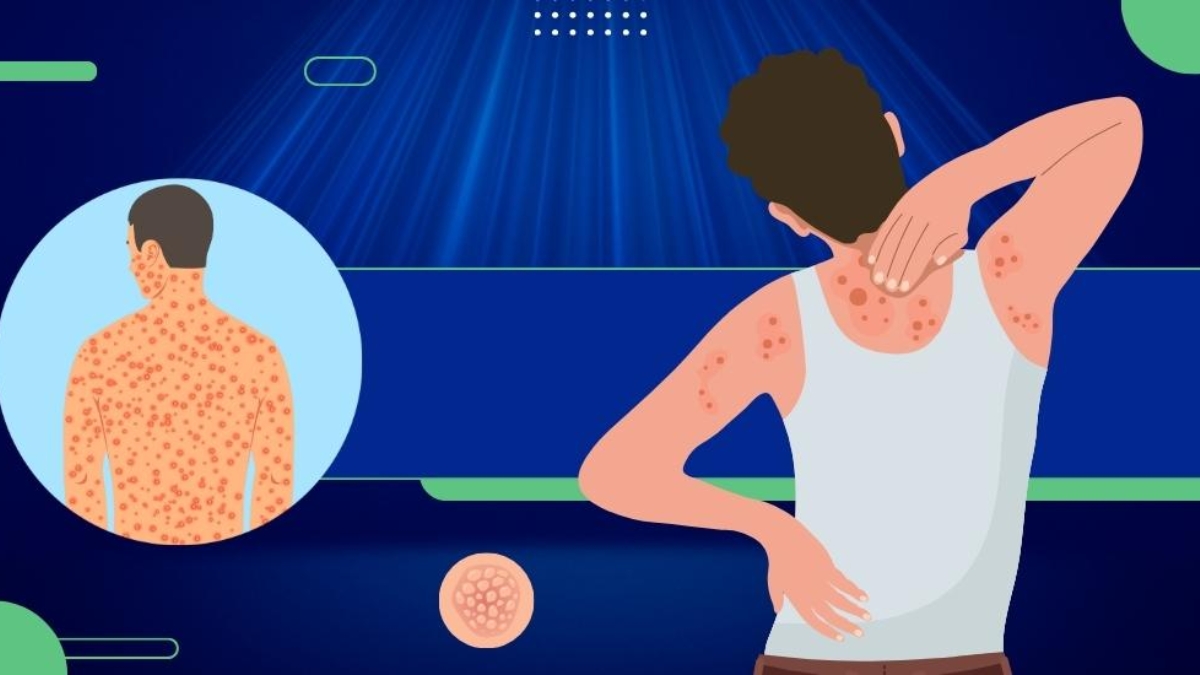 Different Stages of Psoriasis and How They Impact Treatment Options